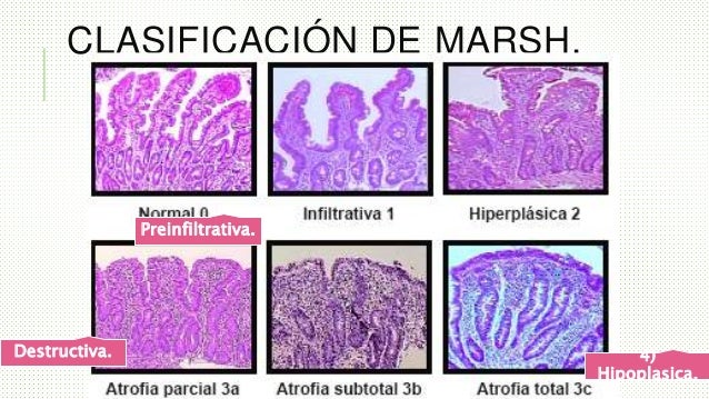 Enfermedad celiaca y esprue tropical