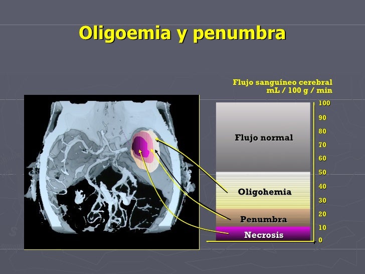 Enfermedad Cerebrovascular