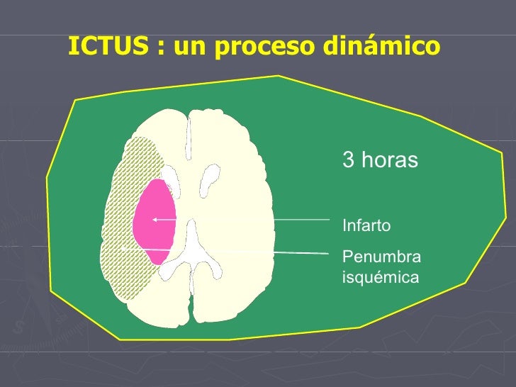 Enfermedad Cerebrovascular