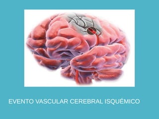 Enfermedad cerebrovascular | PPT