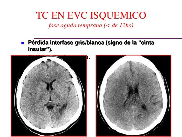 Enfermedad cerebrovascular