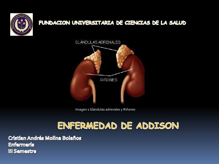 Enfermedad de addison