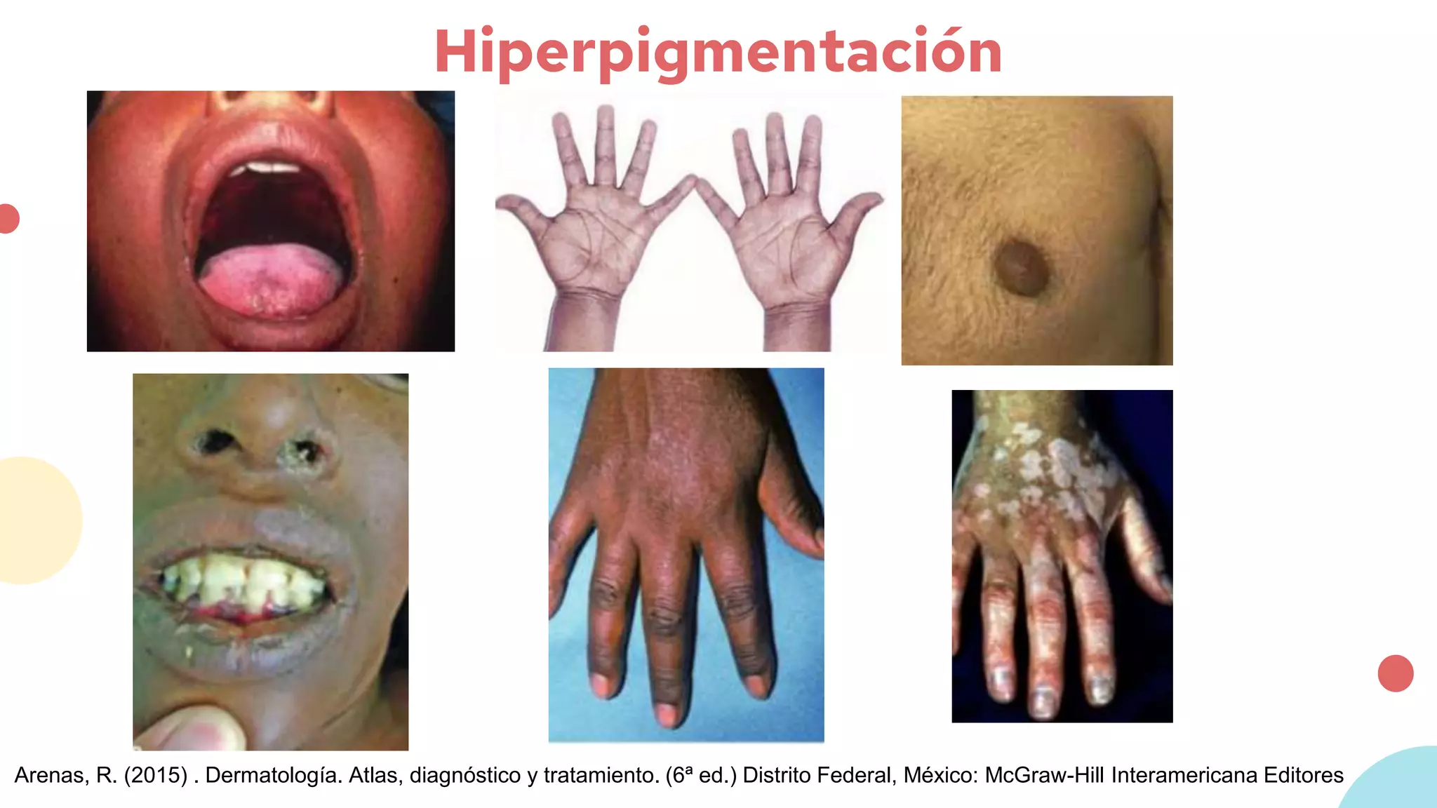Enfermedad de Addison | PPTX