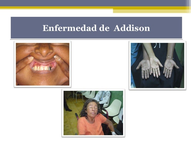 Enfermedad de addison