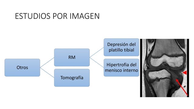 ENFERMEDAD DE BLOUNT O TIBIA VARA .pptx