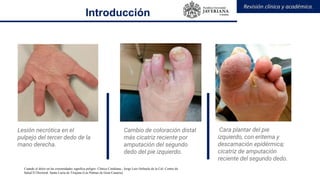Enfermedad de Buerger. | PDF
