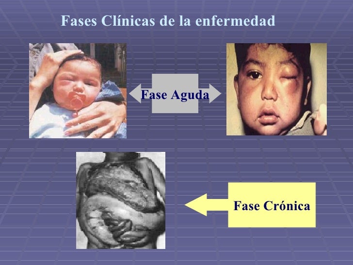 Enfermedad De Chagas