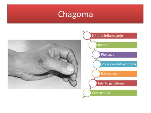 Enfermedad de chagas