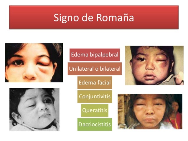 Enfermedad de chagas