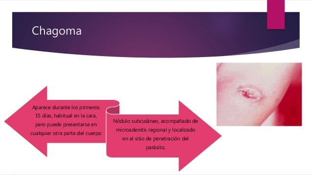 Enfermedad de chagas