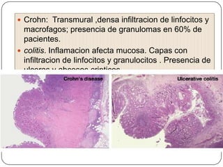 Microscopia de Enfermedad de Crohn y Colitis Ulcerativa | PPTX