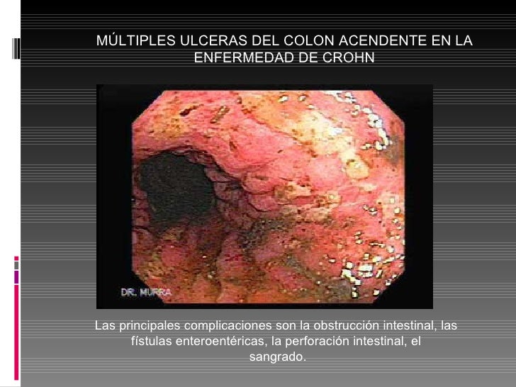 Enfermedad de crhon