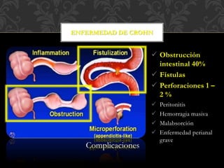Enfermedad de crohn | PPTX