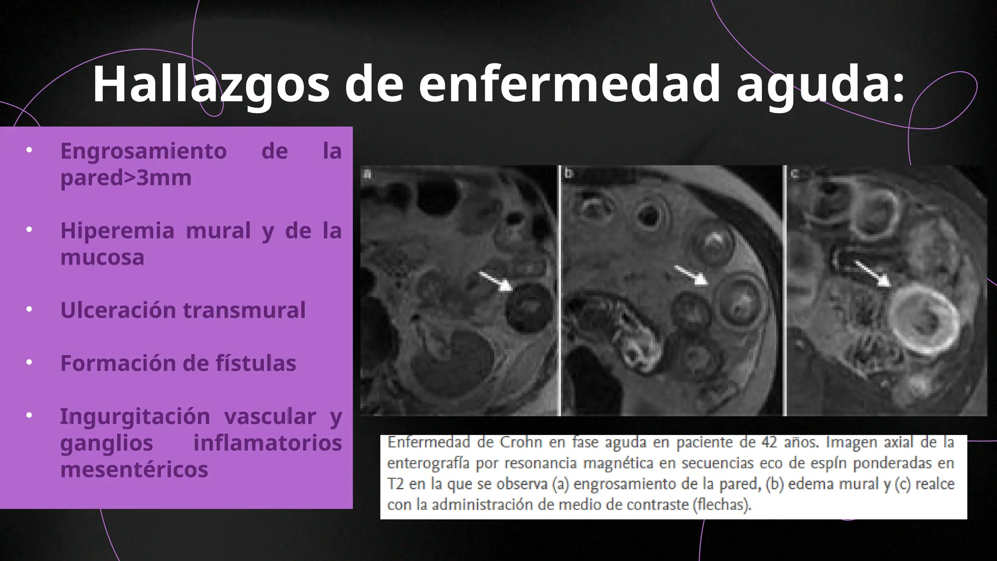 Enfermedad de Crohn y CUCI (colitis ulcerativa cronica inespecifica).pptx
