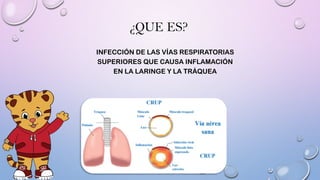 ENFERMEDAD DE CRUP EN NIÑOS patologia respiratoria | PDF