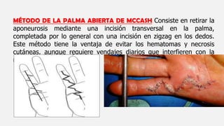 ENFERMEDAD DE DUPUYTREN | PPTX