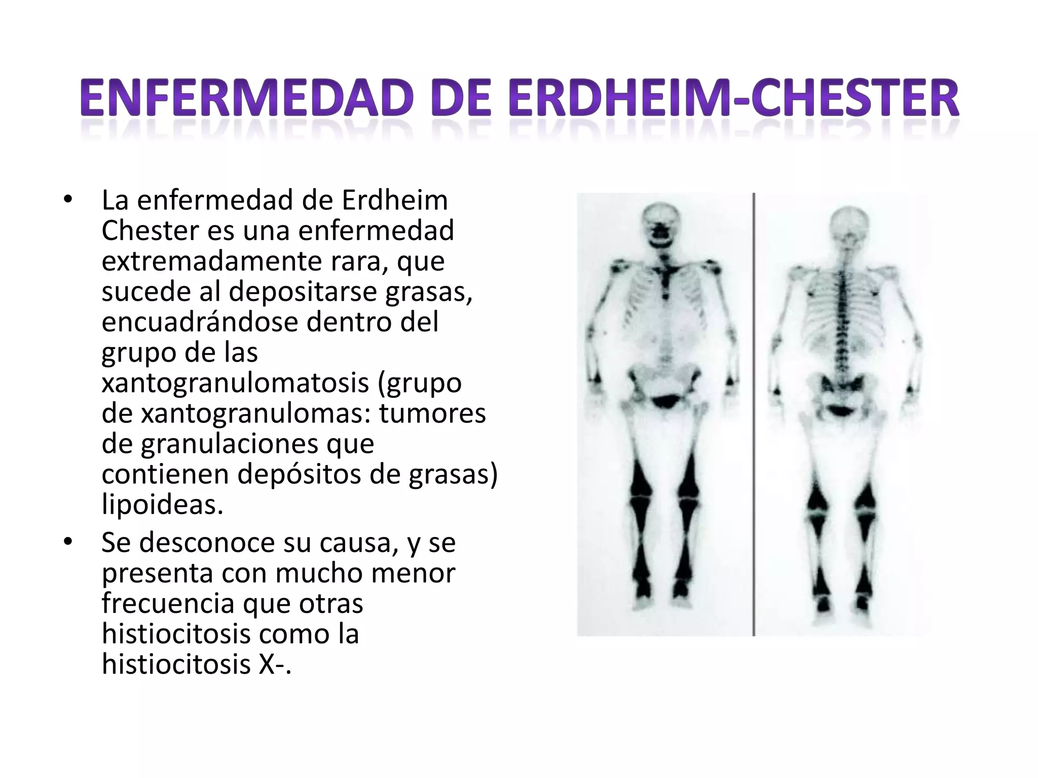 Enfermedad de erdheim chester | PPTX