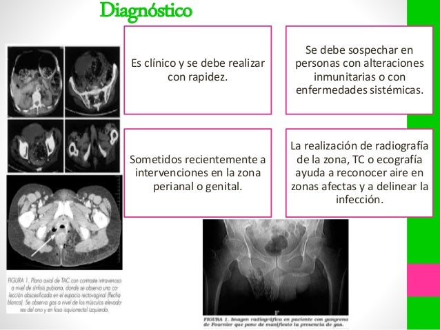 Enfermedad de fournier