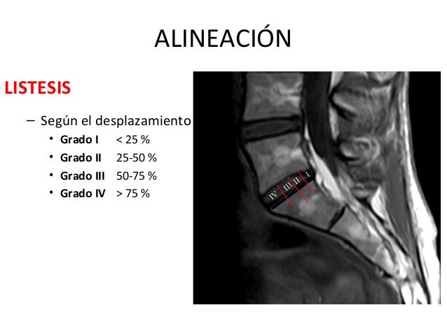 Enfermedad degenerativa en columna lumbar
