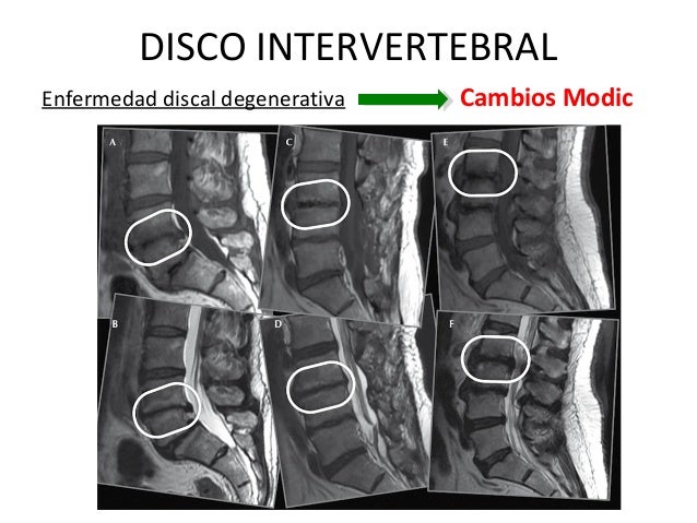Enfermedad degenerativa en columna lumbar