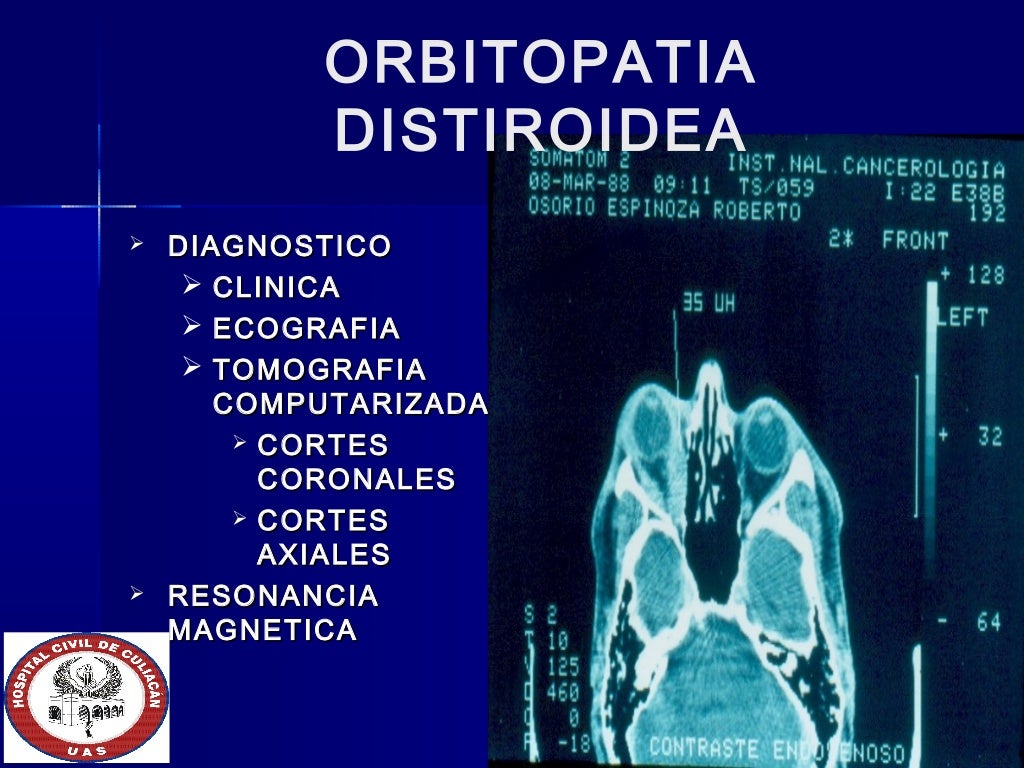 Enfermedad de graves basedow