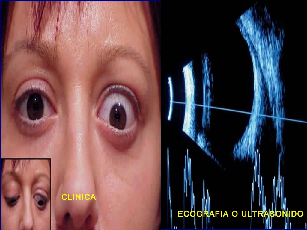 Enfermedad de graves basedow