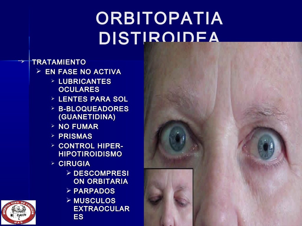 Enfermedad de graves basedow