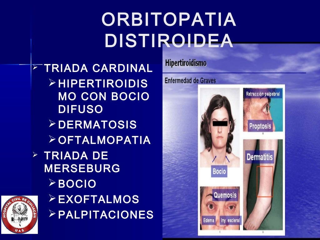 Enfermedad de graves basedow