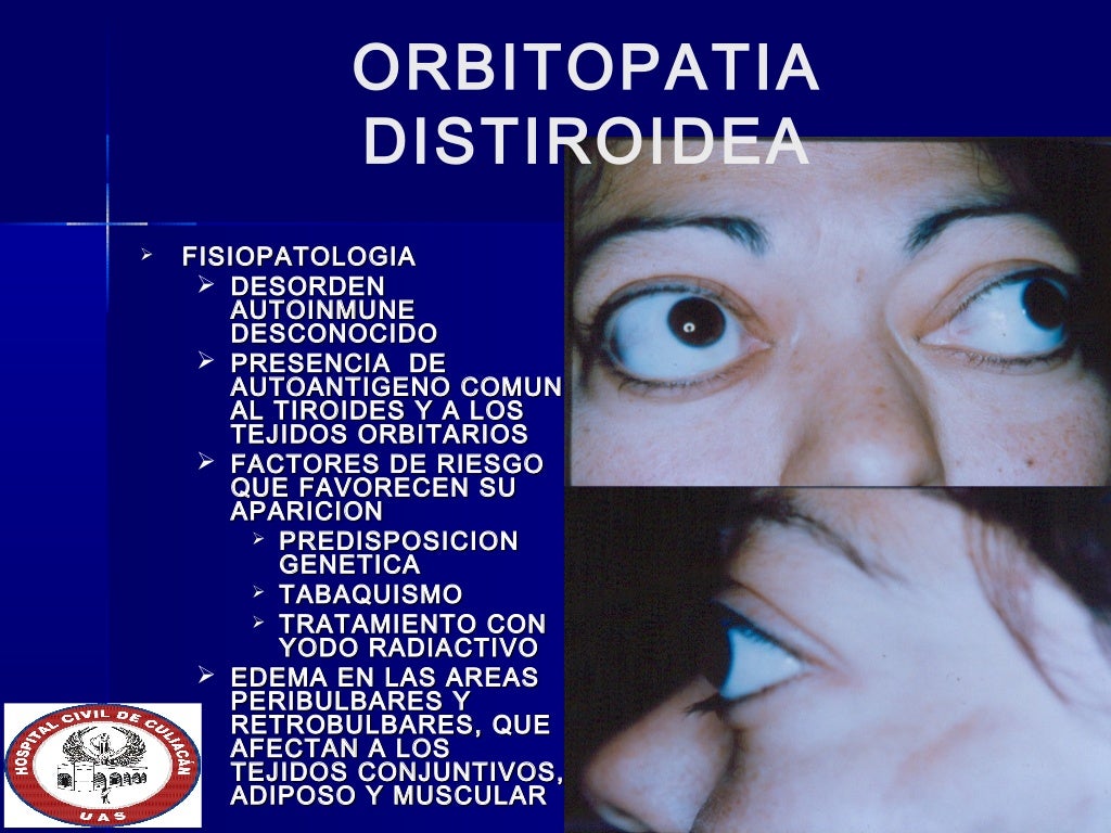 Enfermedad de graves basedow