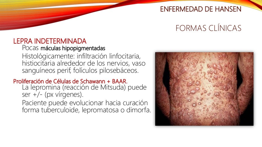 Enfermedad de Hansen