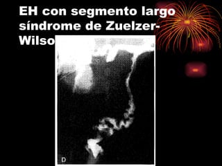 Enfermedad de hirschprung | PPT