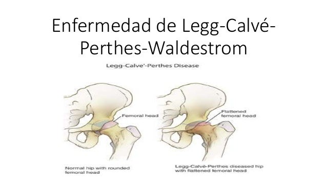 Enfermedad de legg calvé- perthes-waldestrom