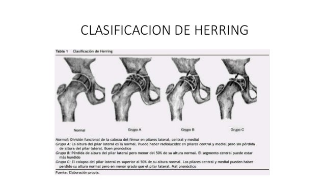 Enfermedad de legg calvé- perthes-waldestrom