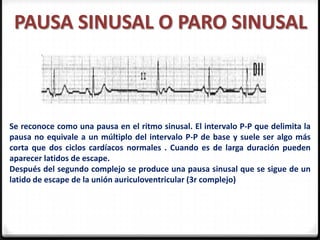 Enfermedad del nodo sinusal | PPTX