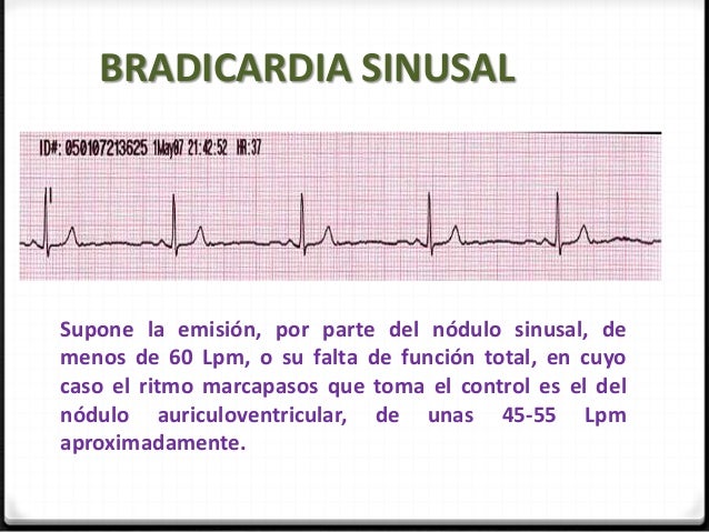 Enfermedad del nodo sinusal
