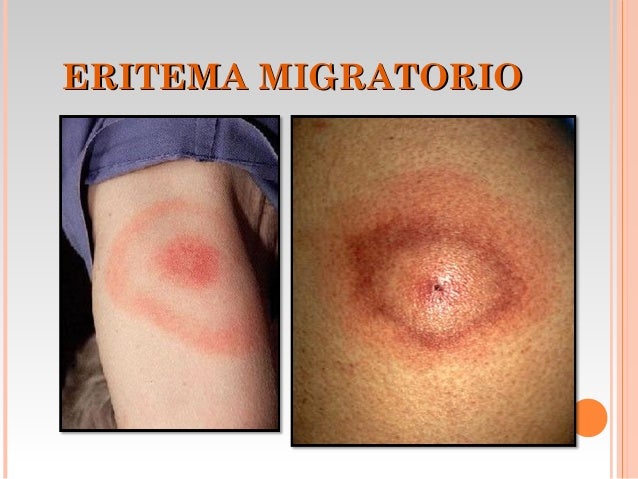 Rosto De Eritema Migratorio Necrolitico Eritema Necrolítico