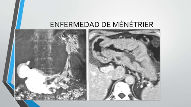 Enfermedad de menetrier | PPT