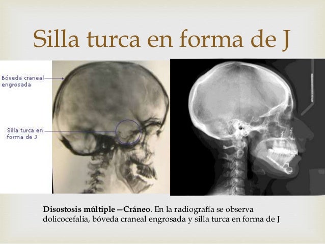 Enfermedad de morquio