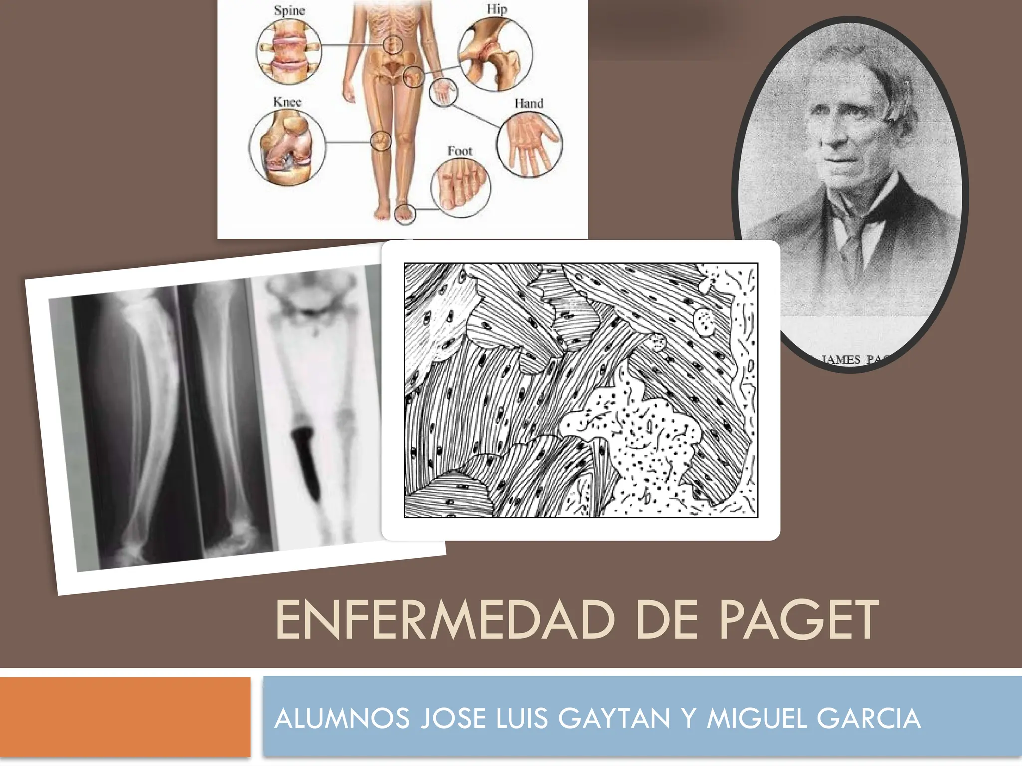 ENFERMEDAD DE PAGET SINTOMAS Y CARACTERISTICAS PARA ESTUDIANTES | PPTX