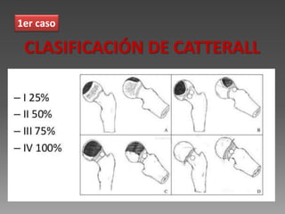 Enfermedad de perthes y epifisiolistesis femoral proximal (Casos ...