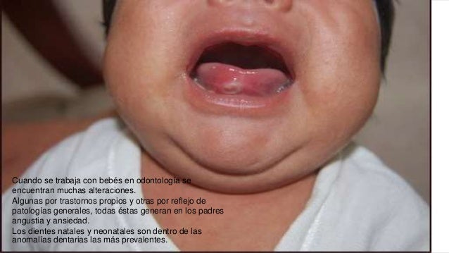 Enfermedad de riga fede