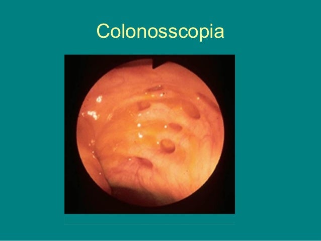 Enfermedad diverticular