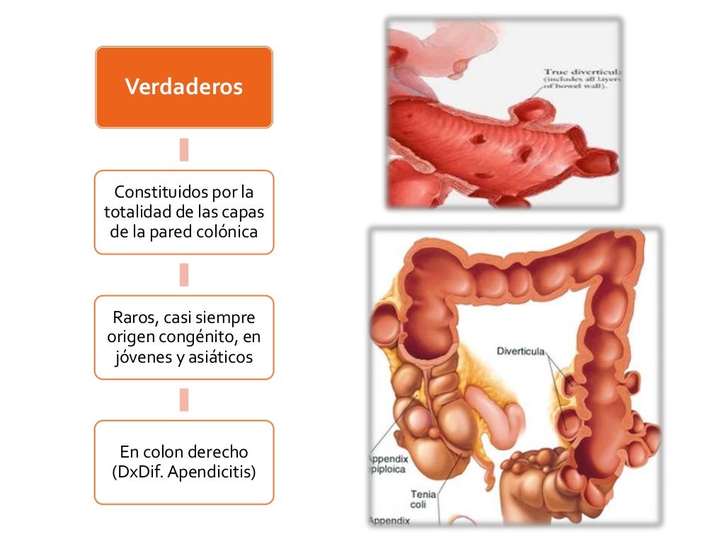Enfermedad Diverticular