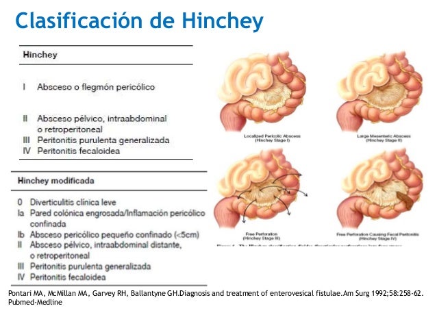 Hinchey Diverticulitis