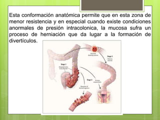Enfermedad diverticular de colon | PPTX