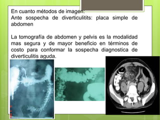 Enfermedad diverticular de colon | PPTX