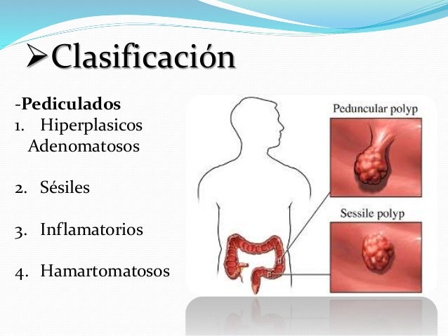 Enfermedad diverticular de colon y Resumen de Polipo de colon