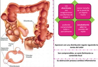 Enfermedad diverticular de colon | PPTX