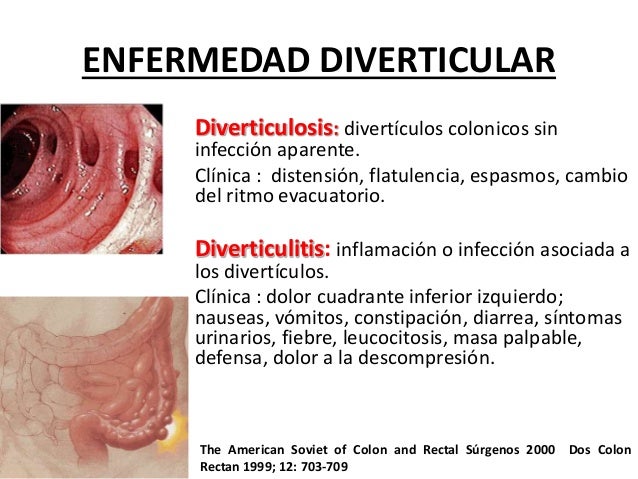 Enfermedad diverticular de colon