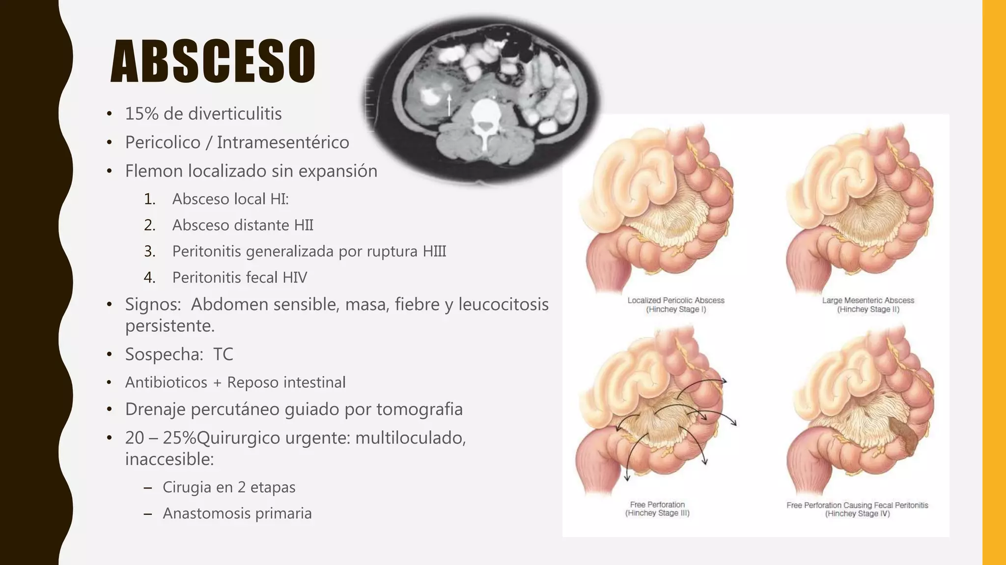 Enfermedad diverticular del colon | PPTX